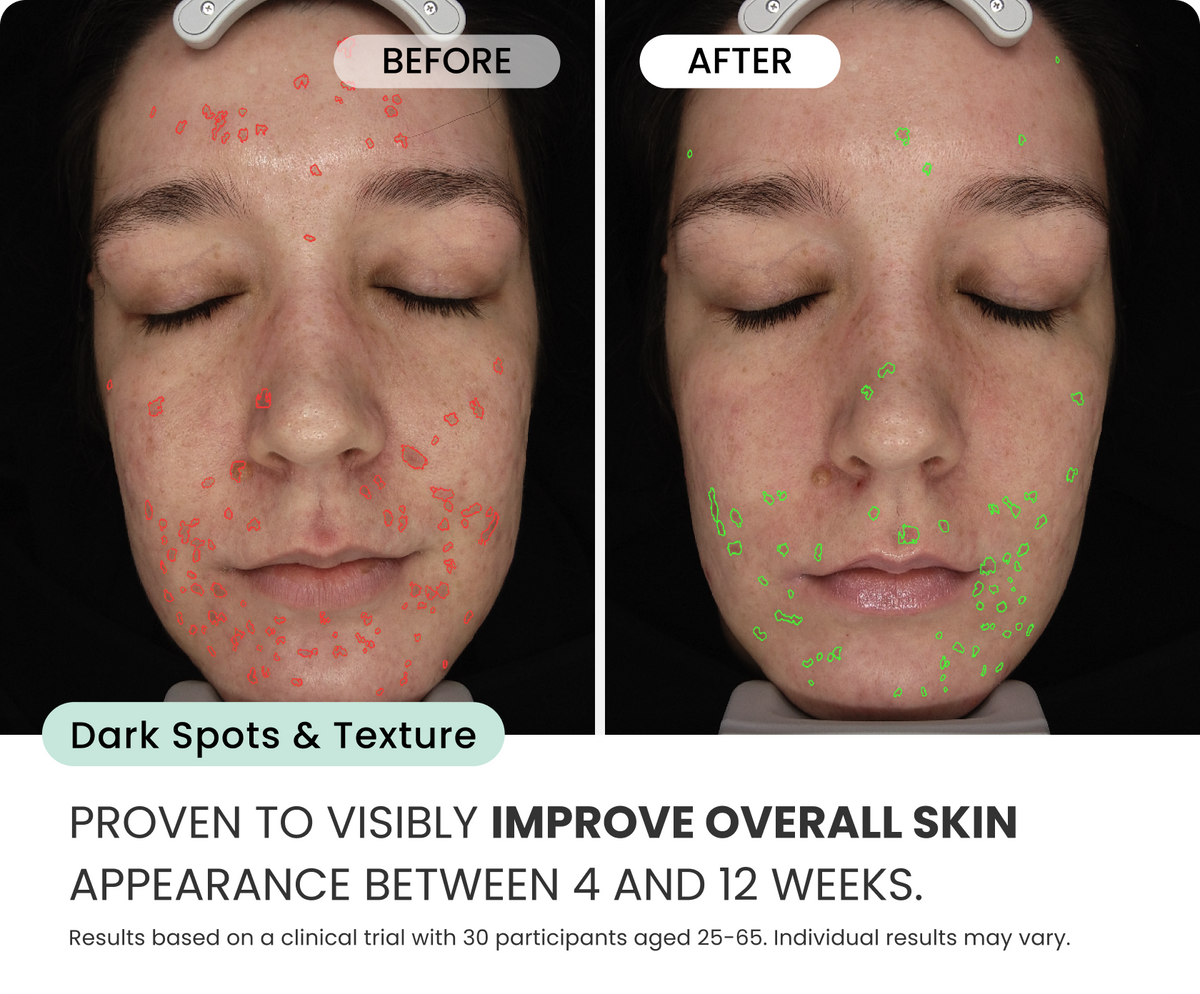 Micro-Infusion System – Qure Skincare