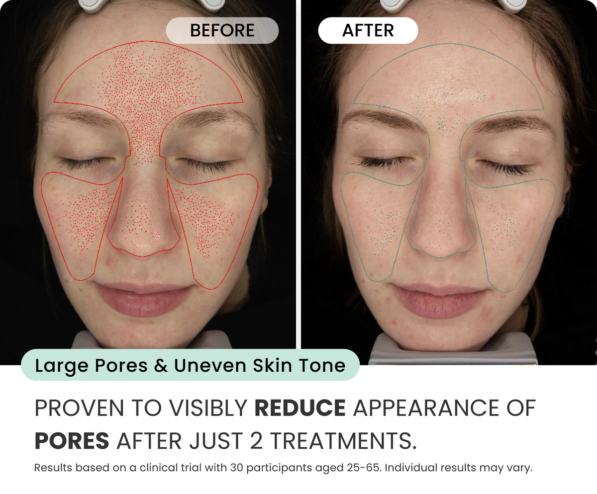 Micro-Infusion System – Qure Skincare