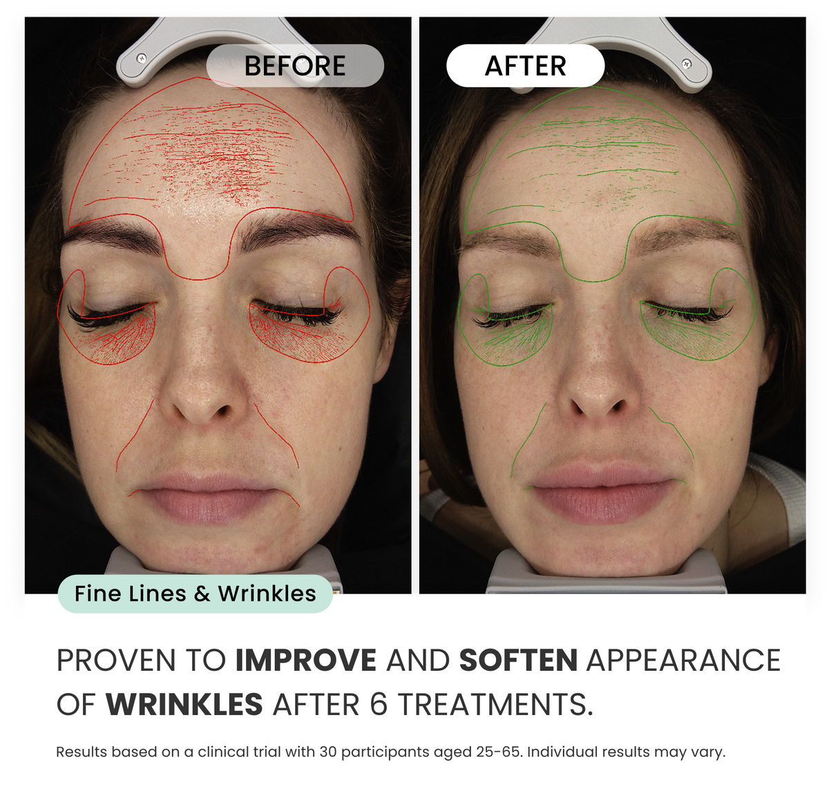 Micro-Infusion System – Qure Skincare