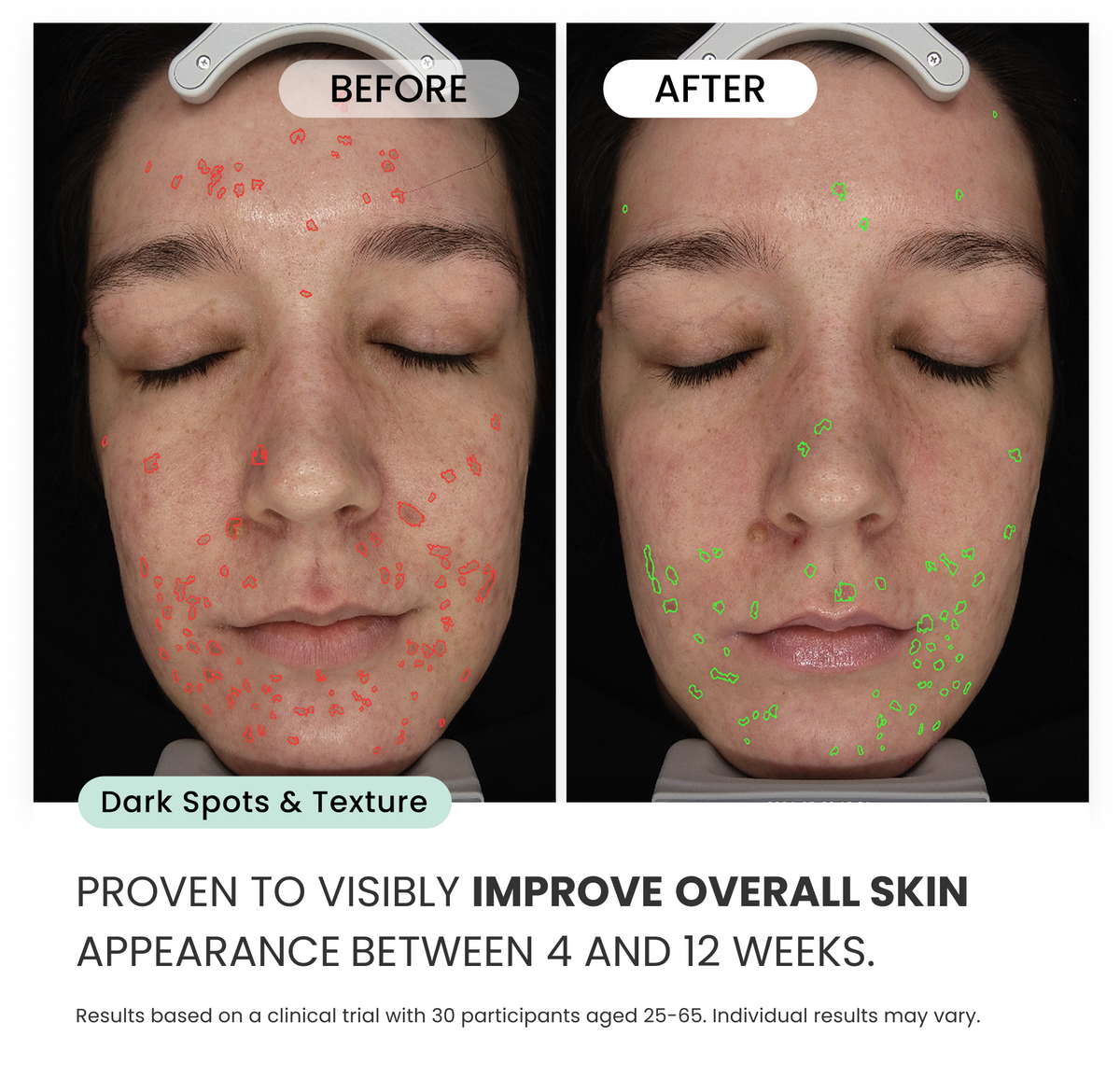 Micro-Infusion System – Qure Skincare