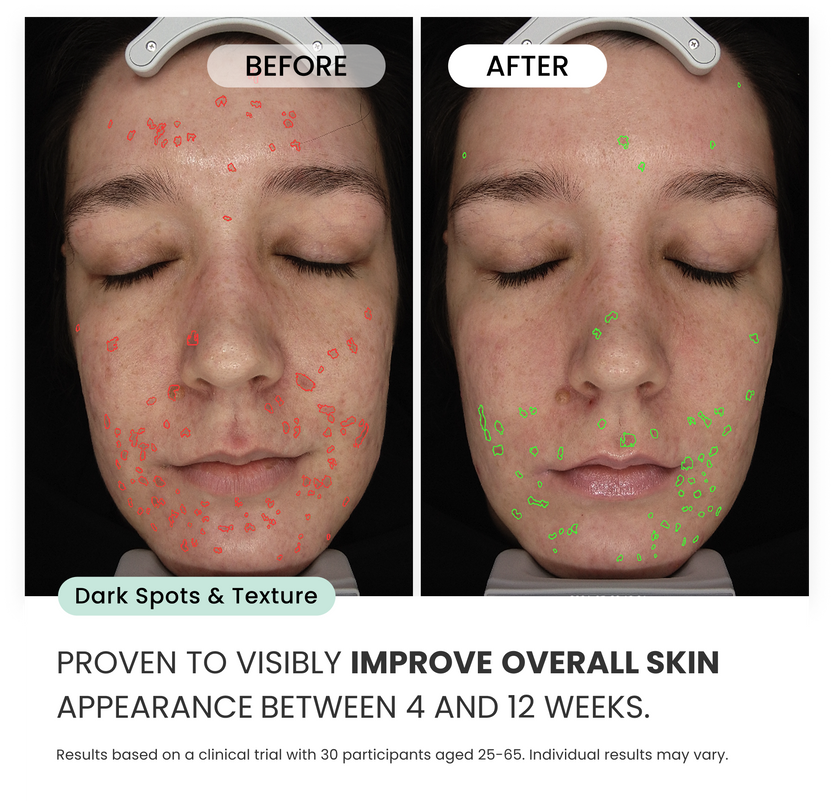 Micro-Infusion System – Qure Skincare