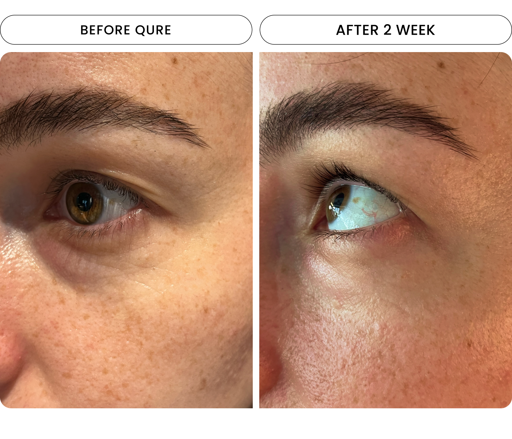 Micro Dart Patches | Target Under Eye Other Facial Areas