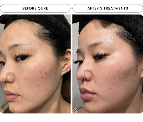 Micro-Infusion System – Qure Skincare