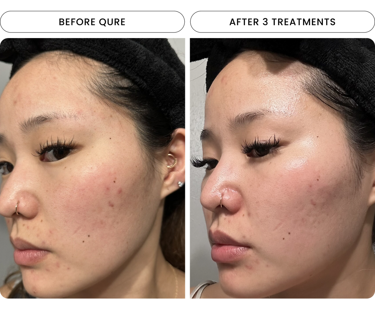 Micro-Infusion System – Qure Skincare