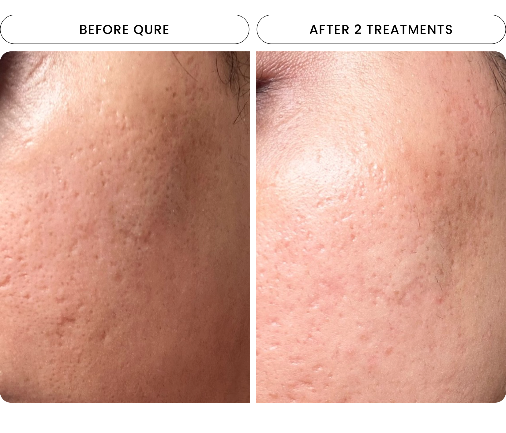 Micro-Infusion System – Qure Skincare