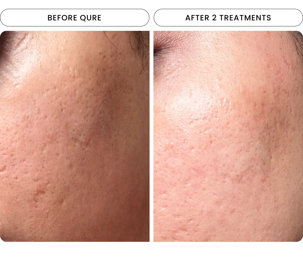 Micro-Infusion System – Qure Skincare