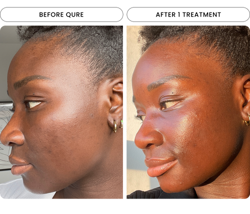 Micro-Infusion System – Qure Skincare