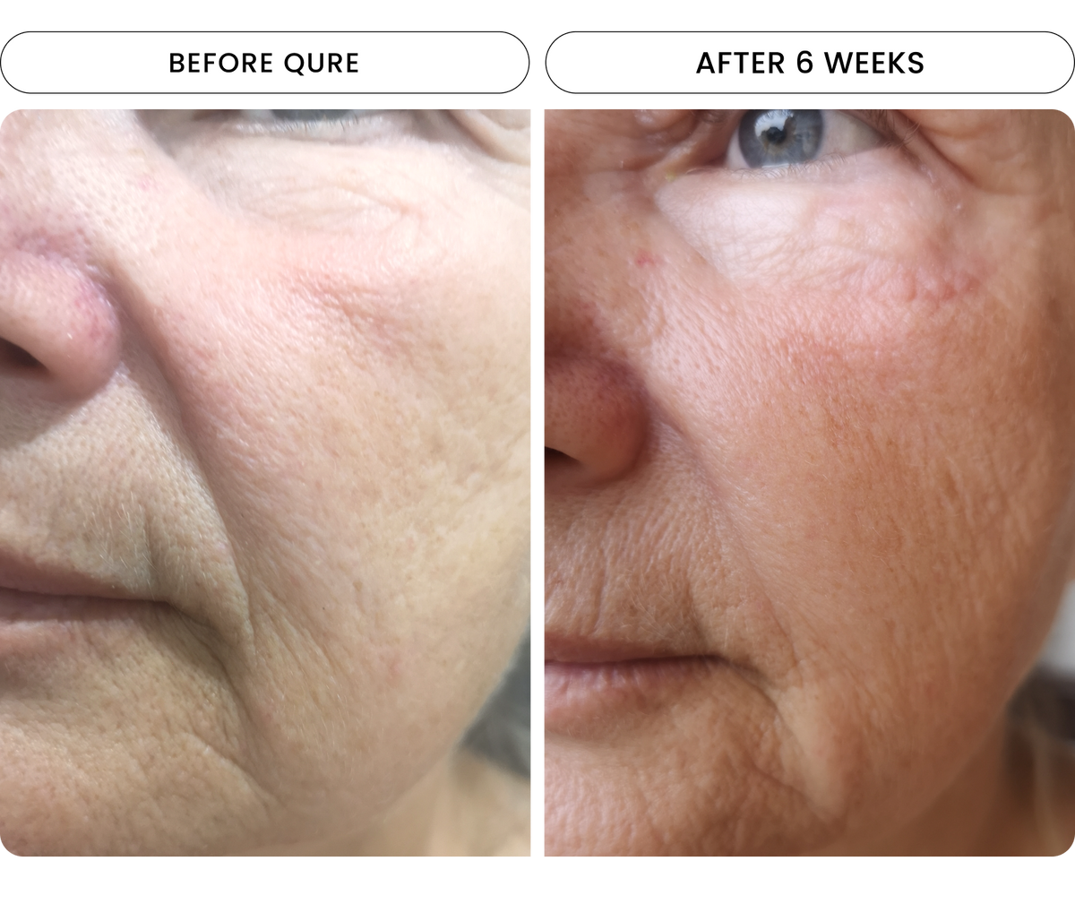 Micro Dart Patches | Target Under Eye & Other Facial Areas