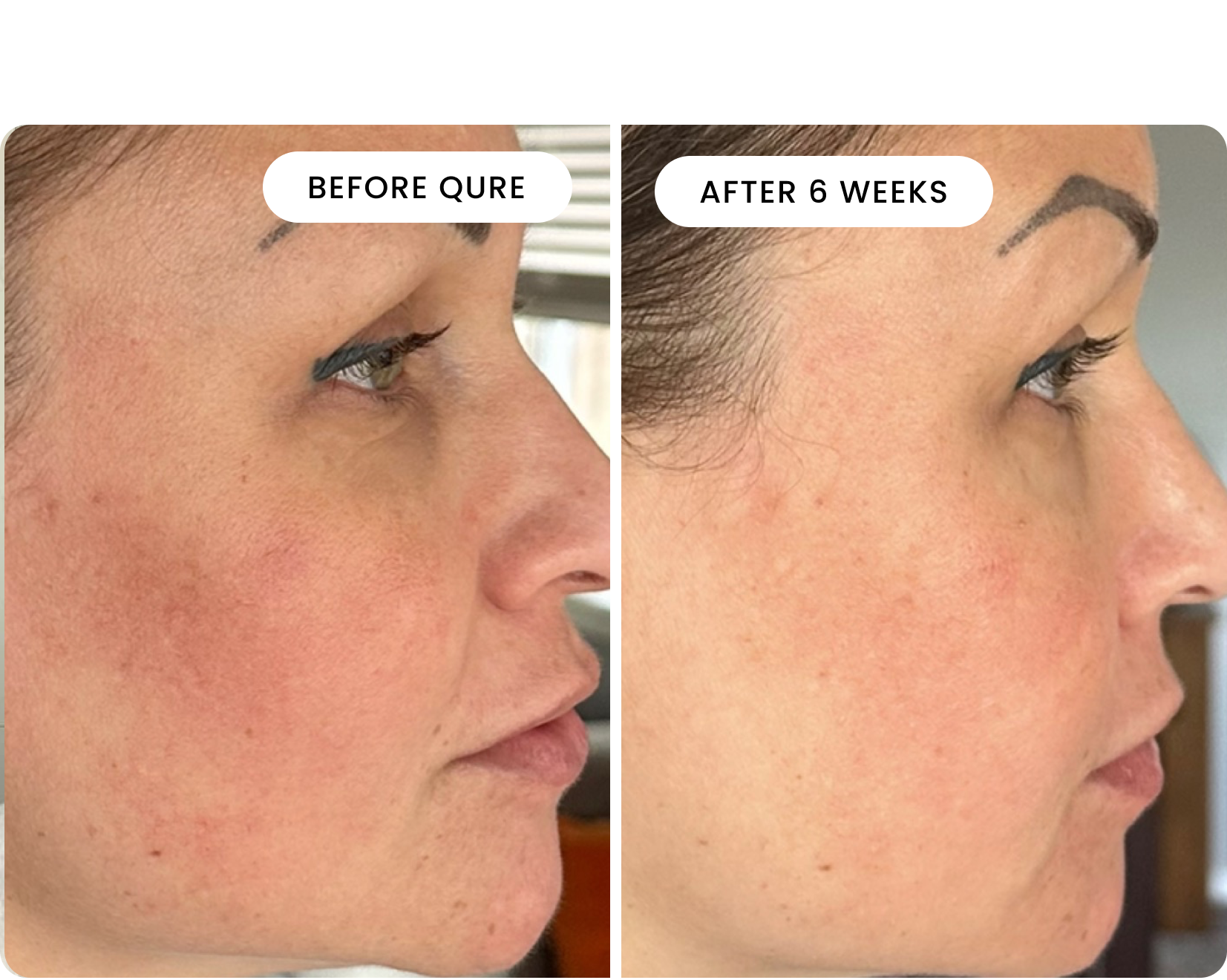 World's First Customizable LED Light Therapy Mask