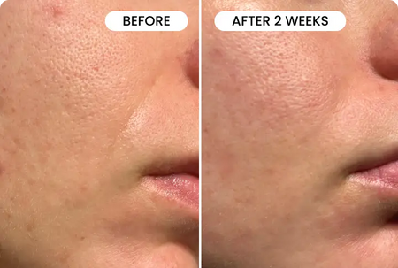 Micro Dart Patches | Target Under Eye Other Facial Areas