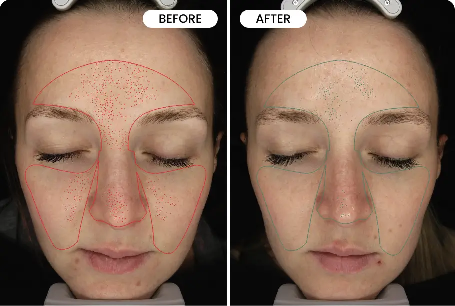 Qure™ Micro-Infusion Facial System